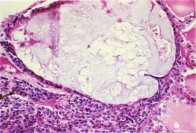 Parathyroid Gland Nonneoplastic Lesion Atlas