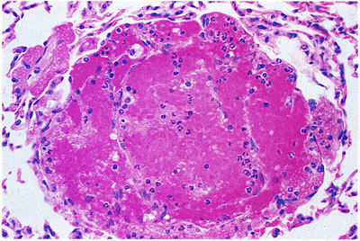 Hemangiosarcoma; Angiosarcoma