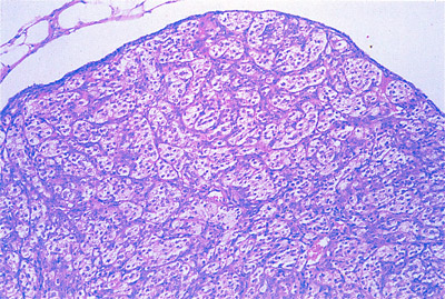 Thecoma; Theca Cell Tumor