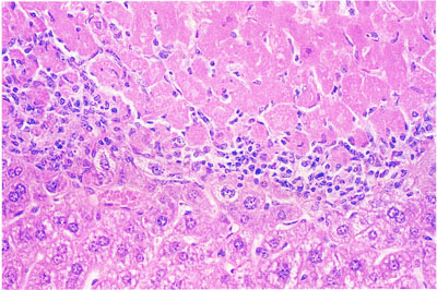 Coagulative Necrosis Liver